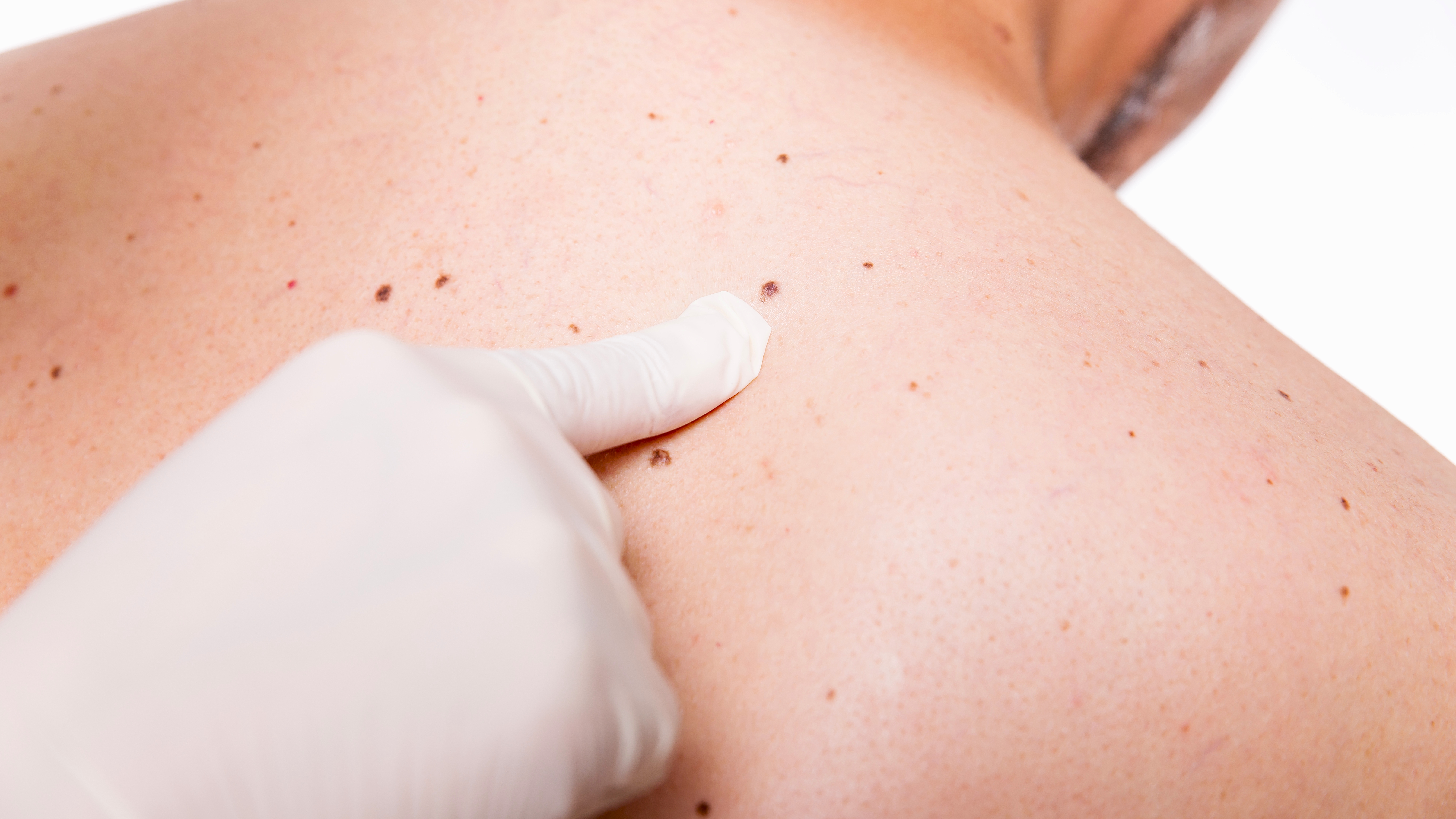 Mole Mobile rolls into the mid-Island for skin cancer screenings | 102.3 The Wave